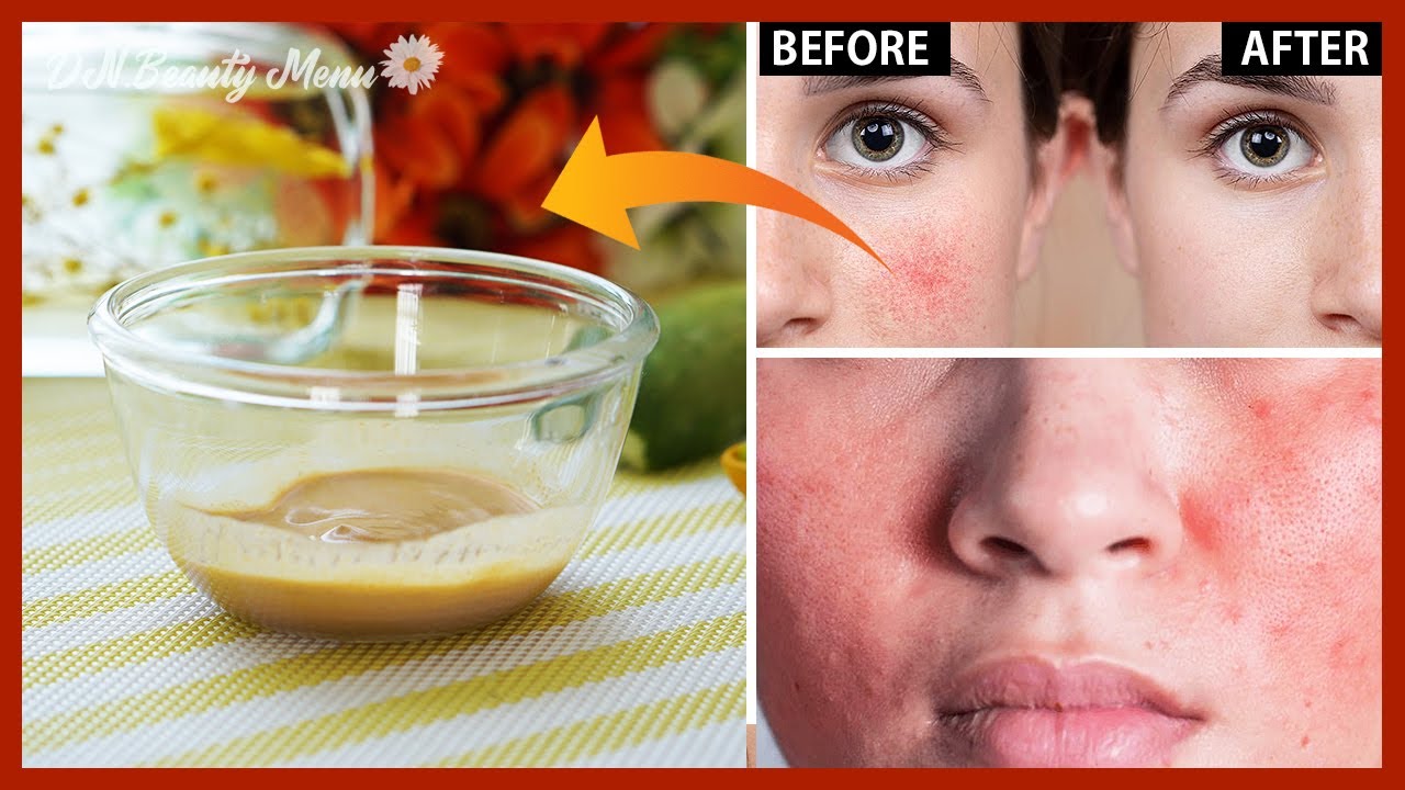 Get rid of Red Irritated skin Menu 15: How to quickly reduce Redness ...