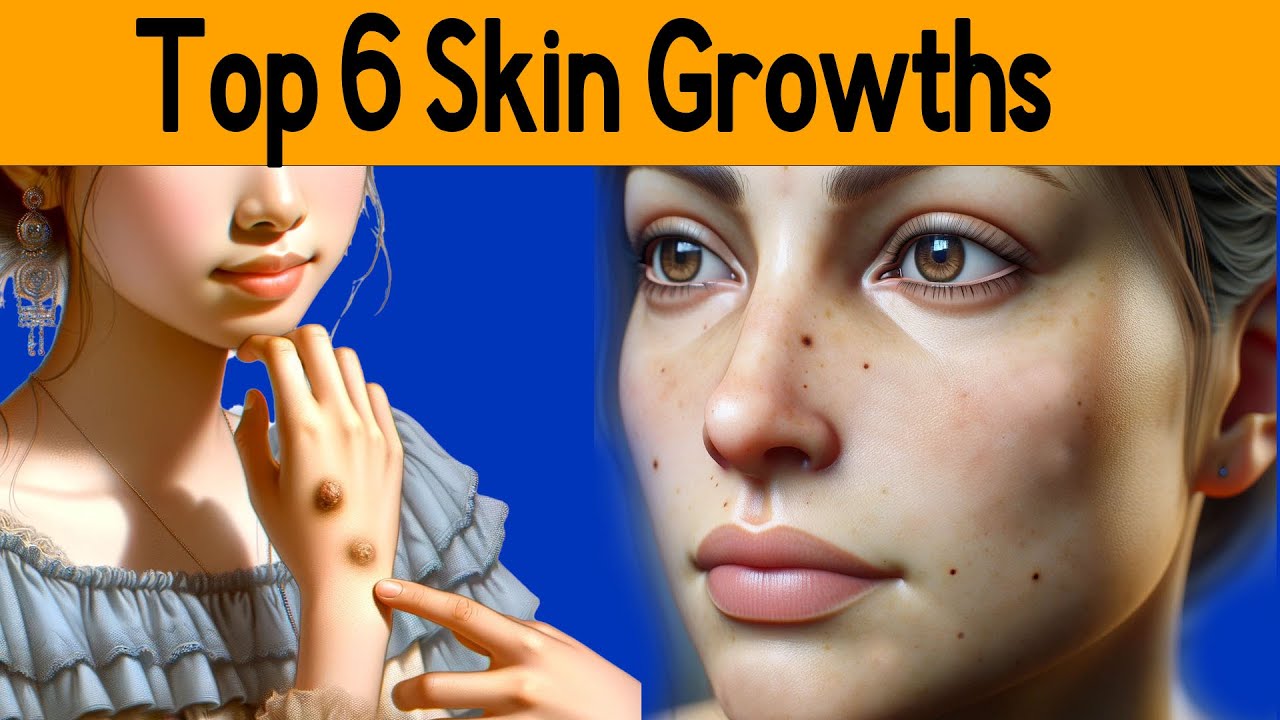 Top 6 six skin growths: From Moles to Warts - A Complete Guide - YouTube