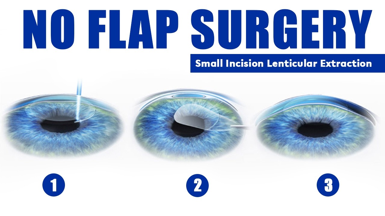 What Is KLEX Eye Surgery? CLEAR 2025 मे चश्मा हटाने का Latest Laser ...