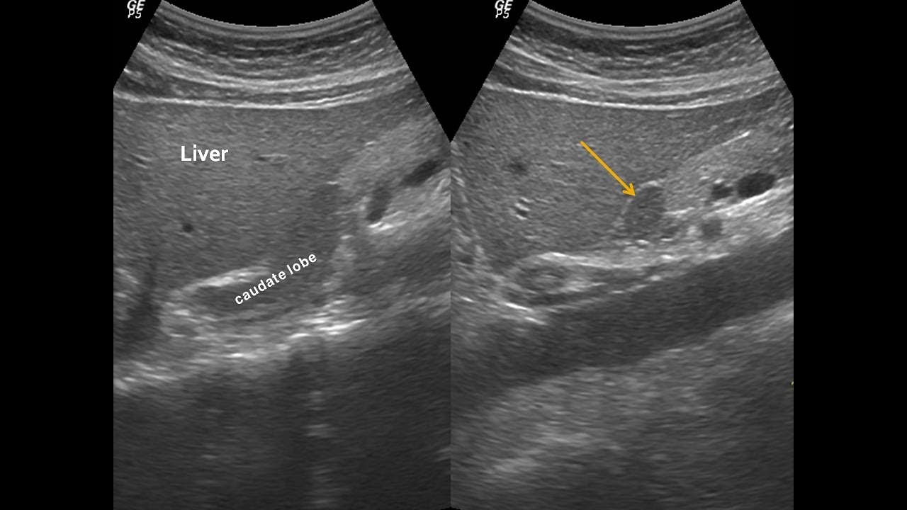 Papillary process of caudate lobe of liver 간 미상엽의 유두상돌기 - YouTube