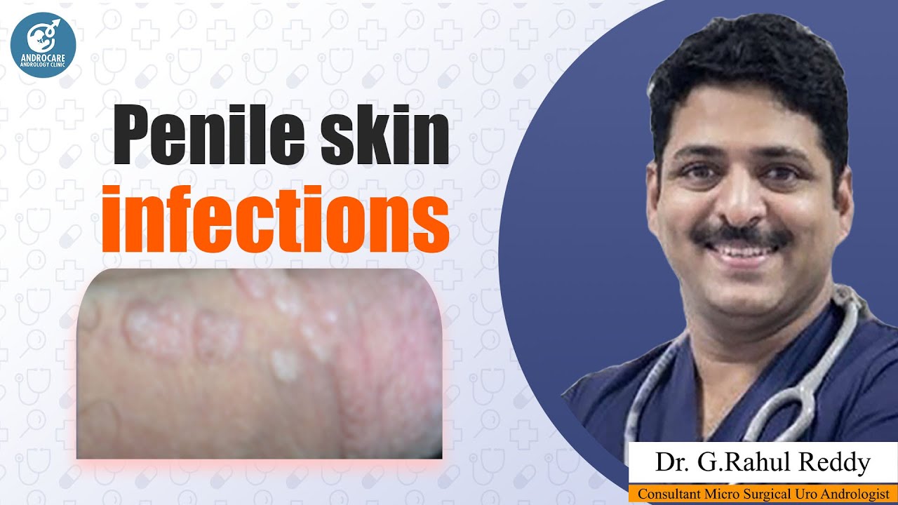 Penile Skin Infections || Dr Rahul Reddy || Androcare Andrology ...