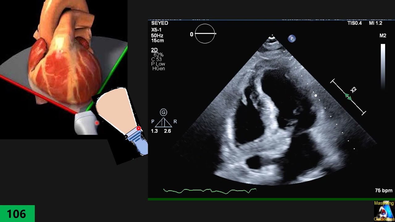 Echocardiographic Anatomy Part 6: Right Ventricle Focused View (RV ...