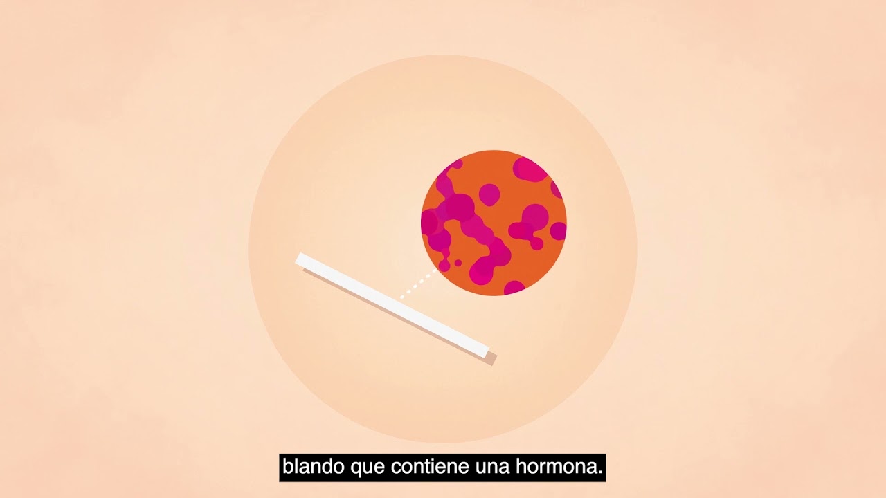 Anticoncepción (About Contraception in Spanish) - YouTube