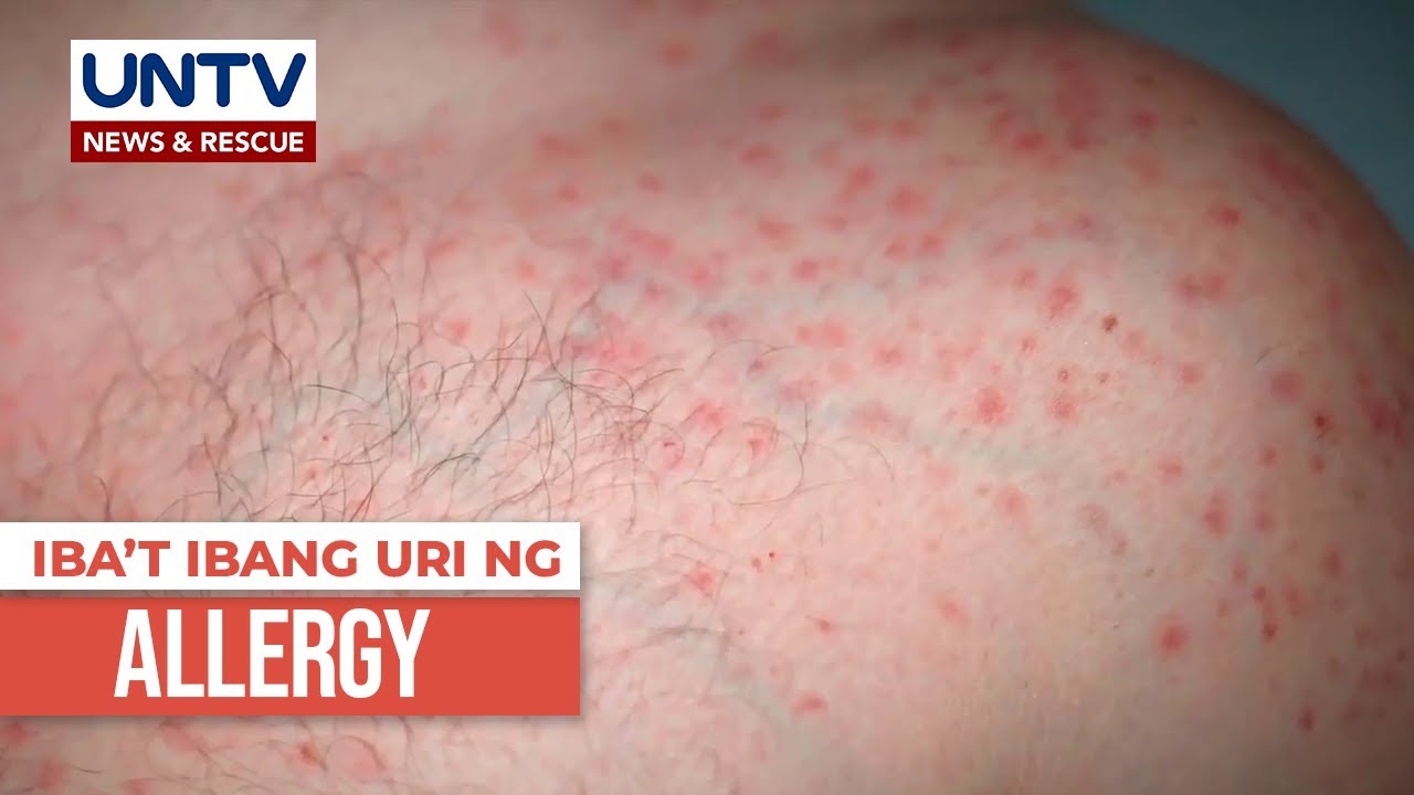 Mga uri ng allergy ayon sa eksperto - YouTube