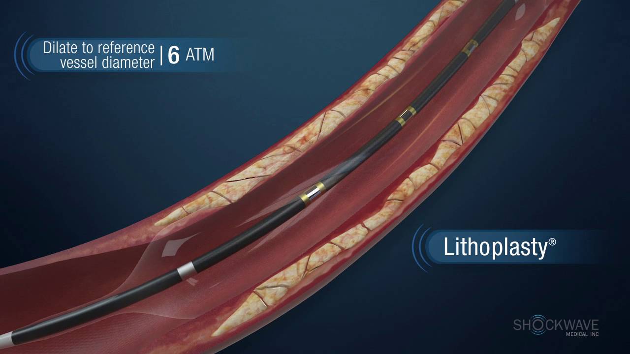 Shockwave Lithoplasty System - YouTube