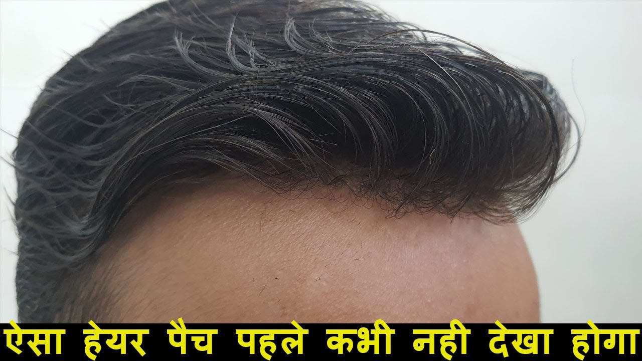 Frontline Hair Patches with Self Tape Attachment Process | Amazing hair ...