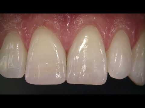 How To Repair Composite Restoration