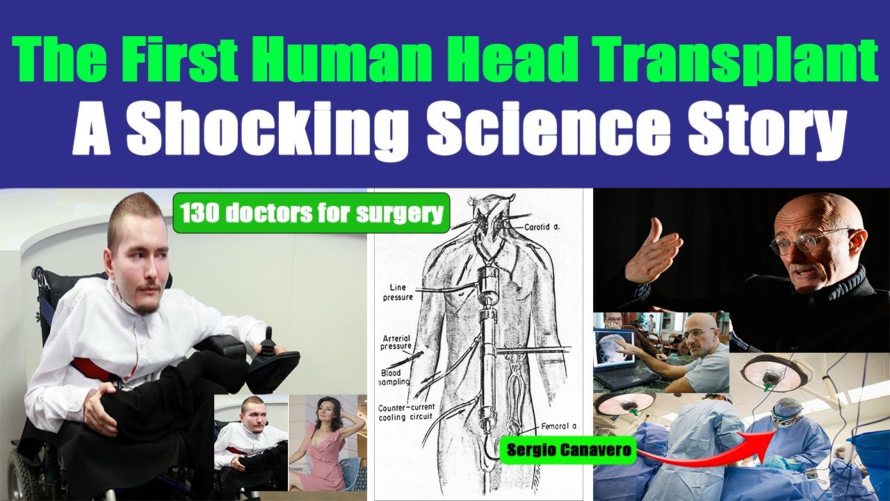 The First Human Head Transplant: A Shocking Science Story - YouTube