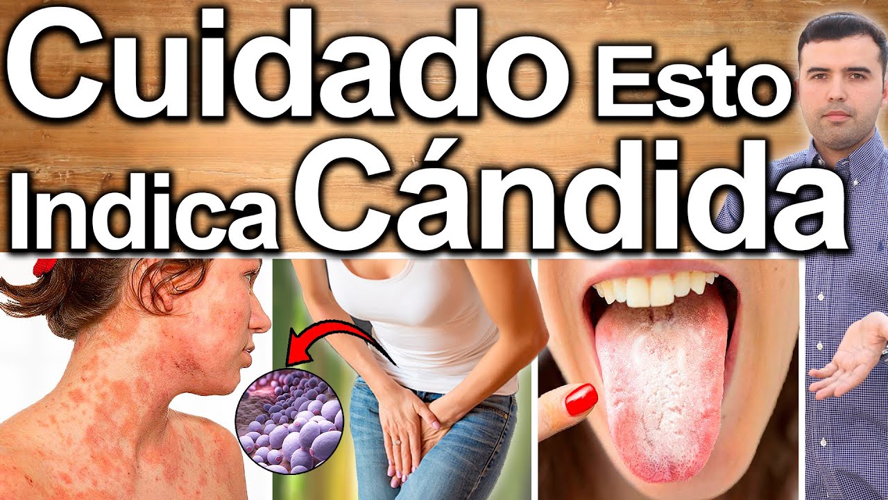 CANDIDA OCULTA - Sintomas Y Como Solucionar O Eliminar Los Hongos - YouTube