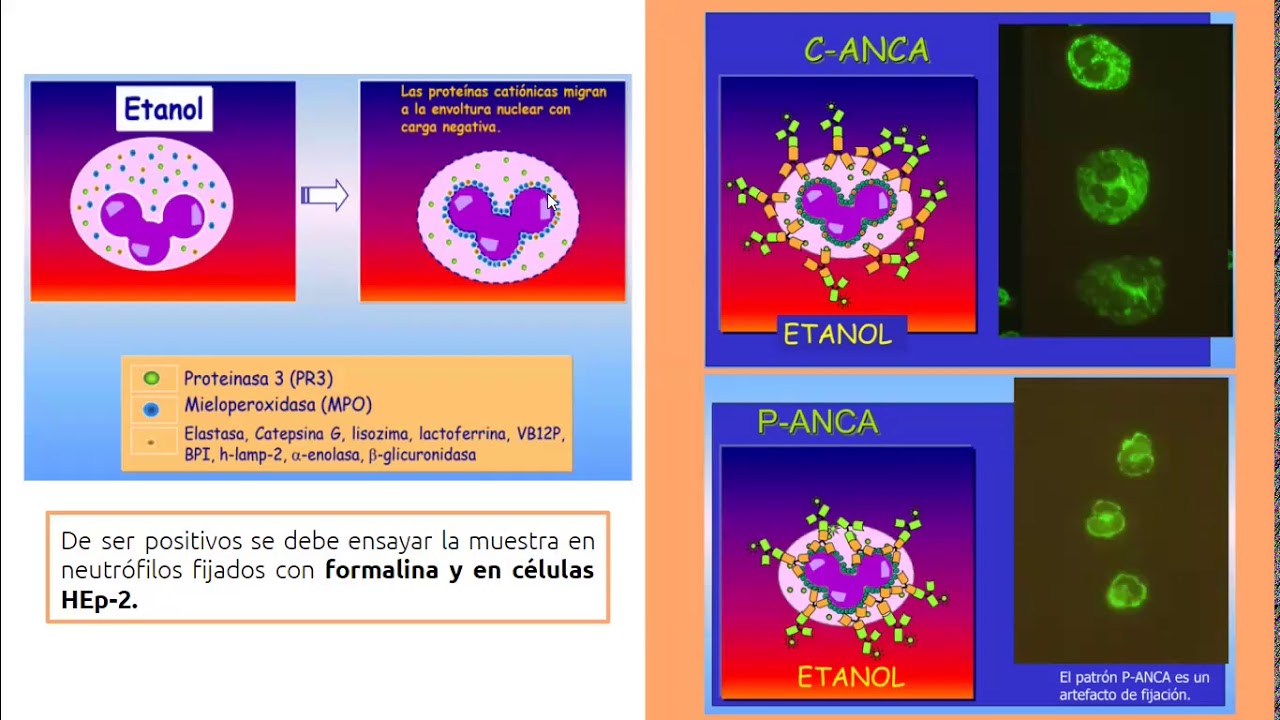 Ateneos Febrero 2021: Complicación en granulomatosis con poliangeítis ...