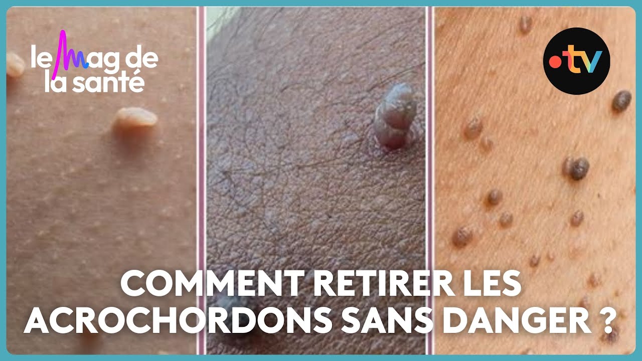 Acrochordons : peut-on retirer ces petites boules de chair soi-même ...
