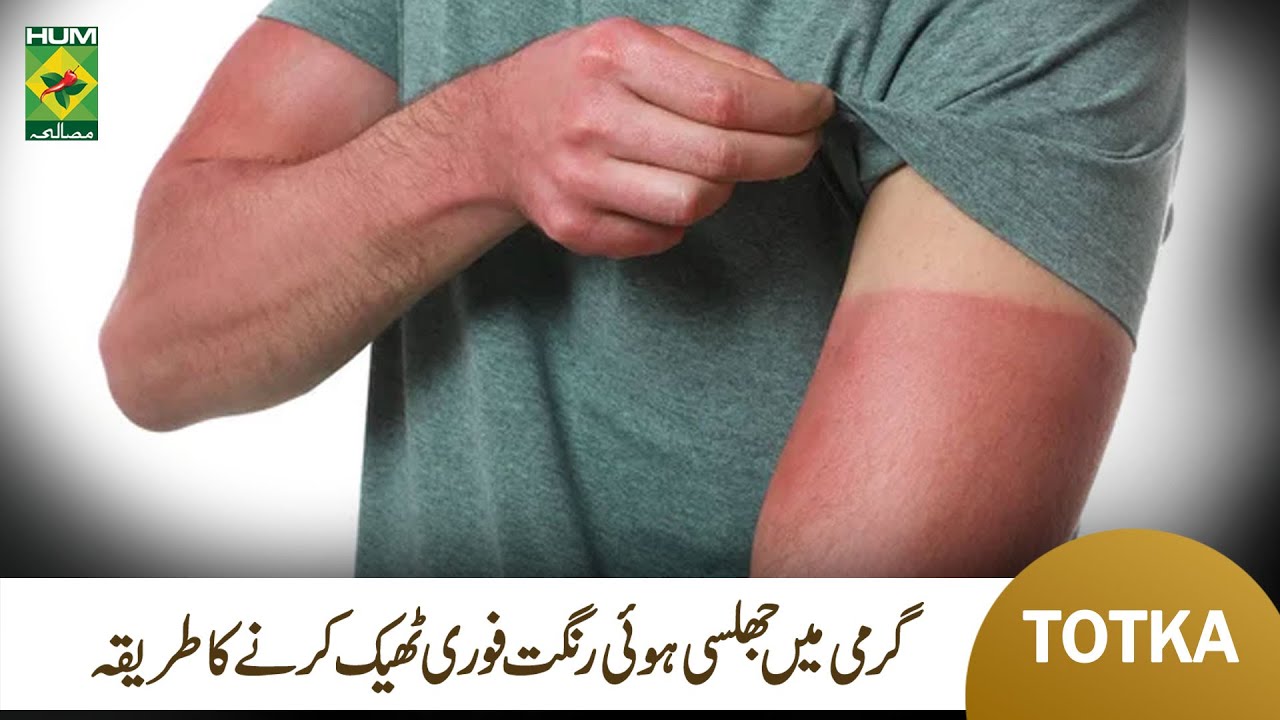 How To Remove Sun Tanning | Sun Burning Skin Treatment | SunBurn Home ...