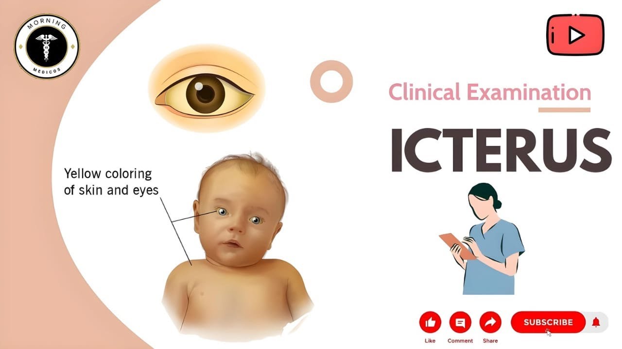 Understanding Icterus: Symptoms, Causes, and Treatment Options - YouTube