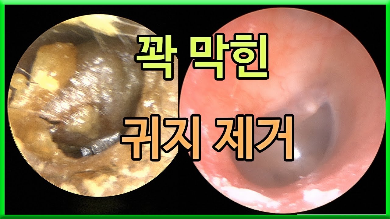 꽉 막힌 귀지 제거 | 이비인후과에서 딱딱한 귀지 제거하는 내시경 영상 | cerumen impaction | hard ear ...