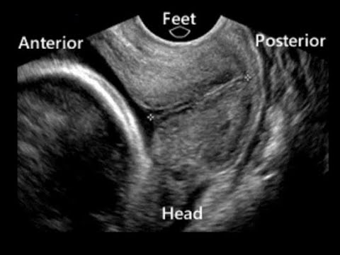 How To Measure the Cervical Length by Transvaginal Ultrasound - YouTube