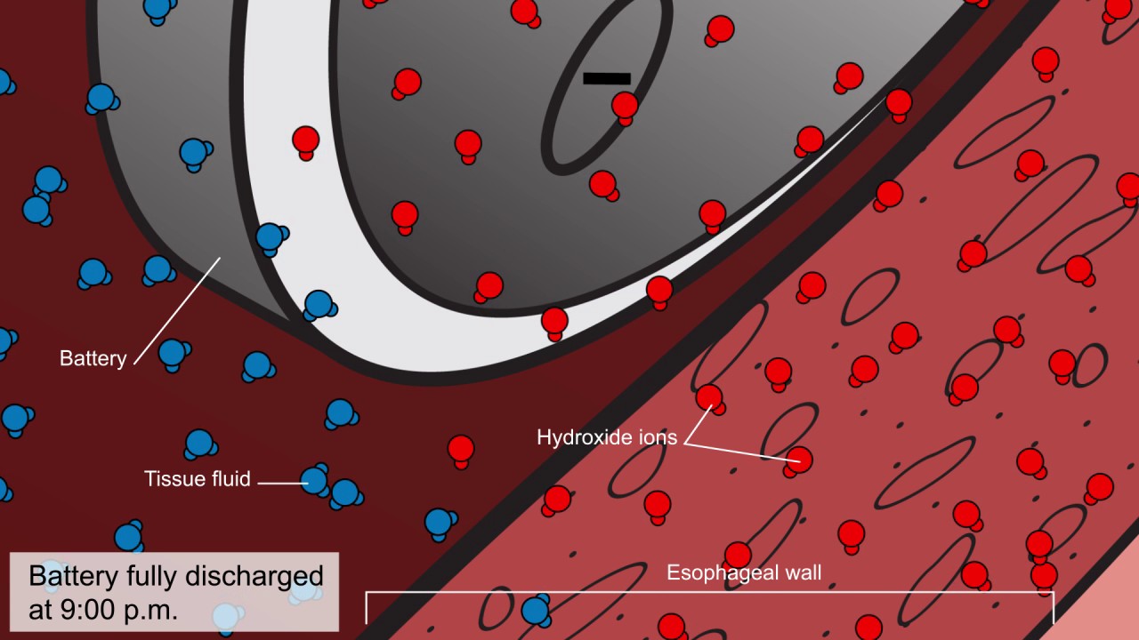 Button battery stuck in esophagus - YouTube