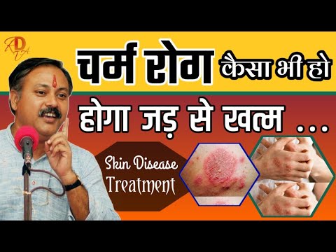 charm rog ki dava | skin disease ka ilaj | eczema treatment | Rajiv ...