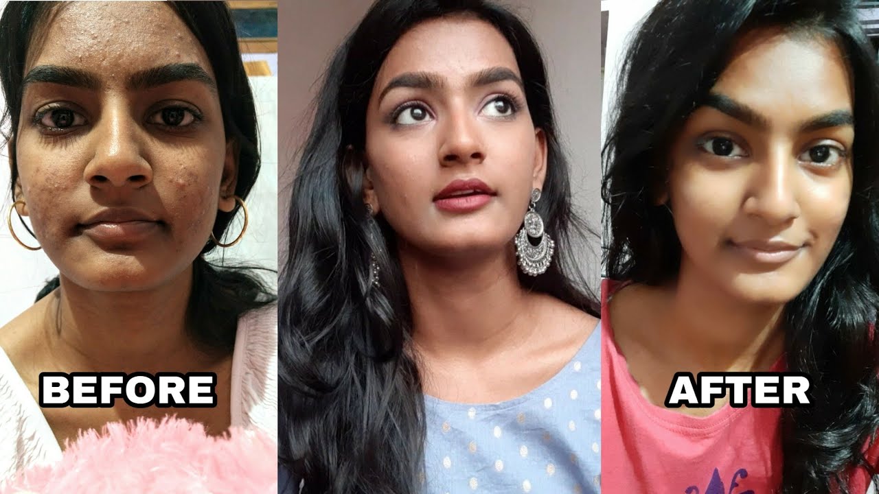 How I Cleared My Acne In Just 30 Days | Acutret, Acutret20 ...