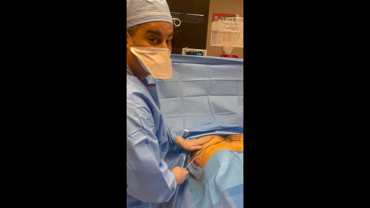 Gynecomastia Excision Nov 2021 - YouTube