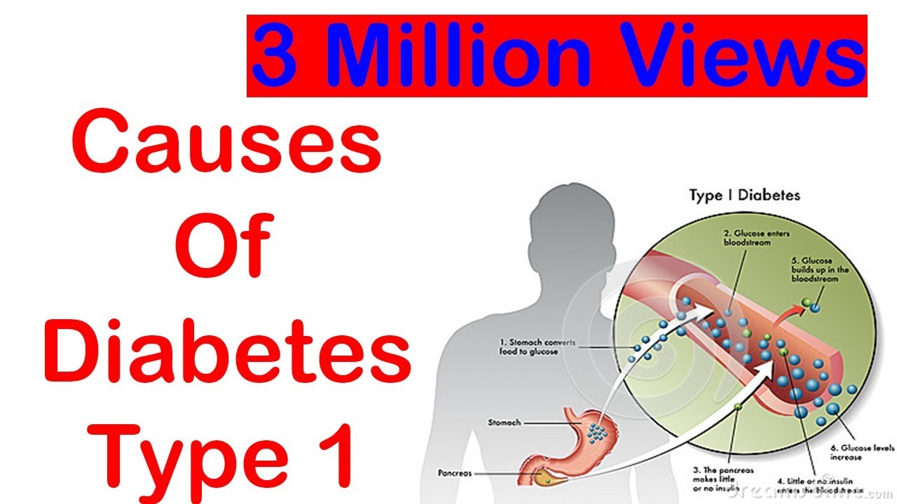 What Causes Diabetes Type 1 (Must Watch For Diabetes Sufferers) - YouTube