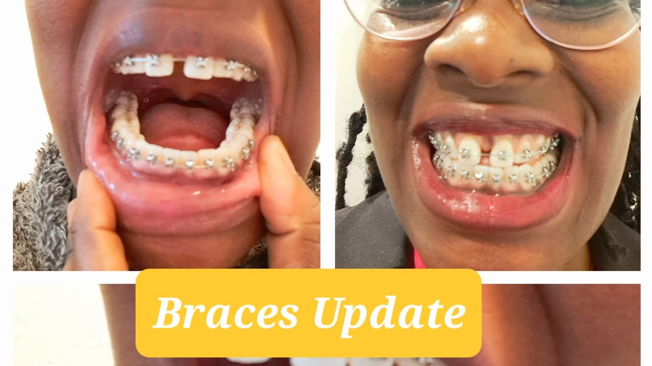 Advantages Of Braces/ Braces Update - YouTube