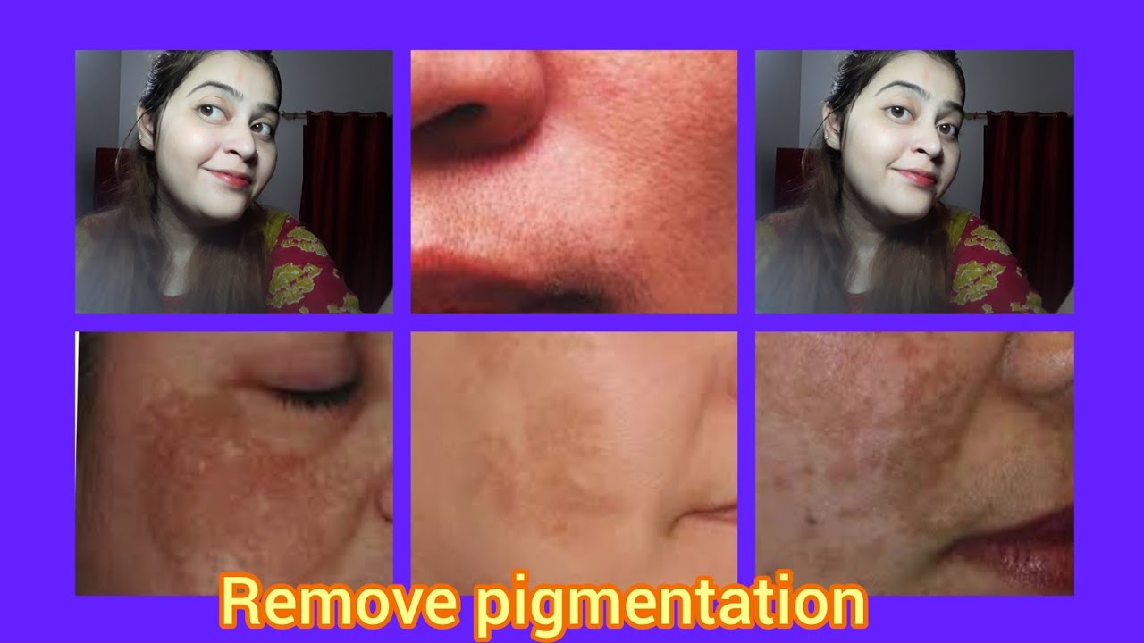 How To Get Rid Of Dark Spots||Brown Spots||Pigmentation - YouTube