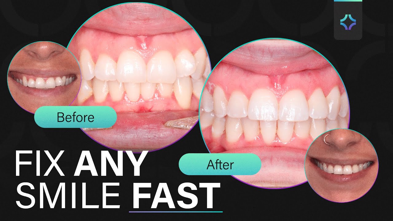 HELP YOUR PATIENTS ACHIEVE THE PERFECT SMILE! How TADs and Invisalign ...
