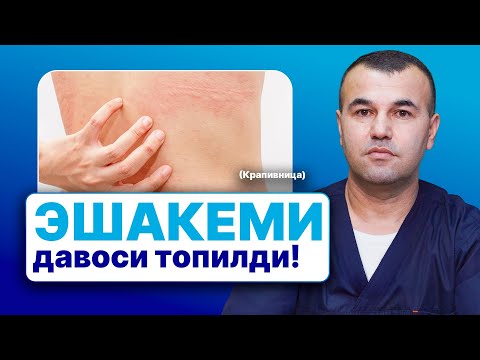 Эшакеми, Крапивница — сабаблари ва даволаш усуллари | 90 788 83 13
