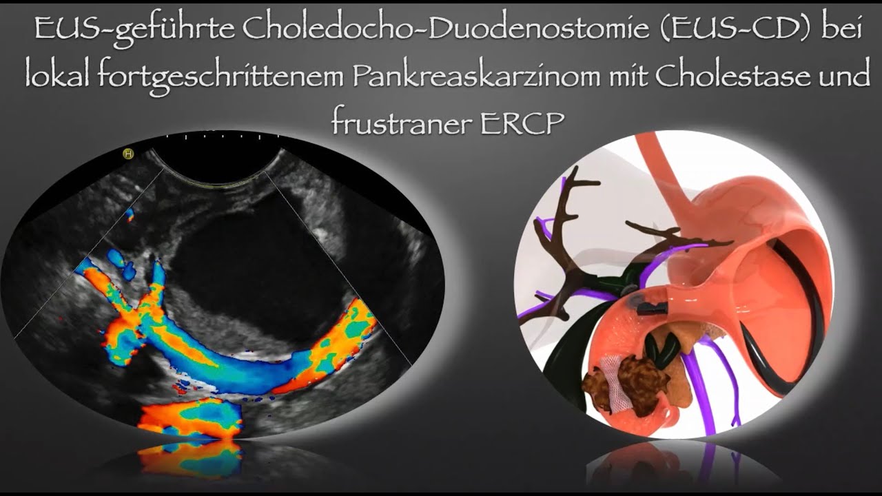 EUS-geführte Choledocho-Duodenostomie (EUS-CD) - YouTube