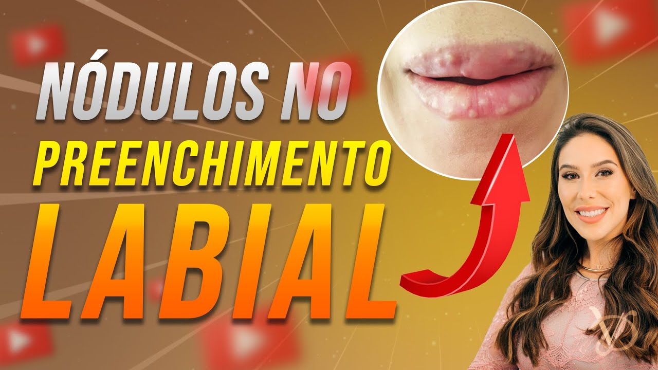 NÓDULOS NO PREENCHIMENTO LABIAL | DRA VANESSA DEFELÍCIBUS - YouTube