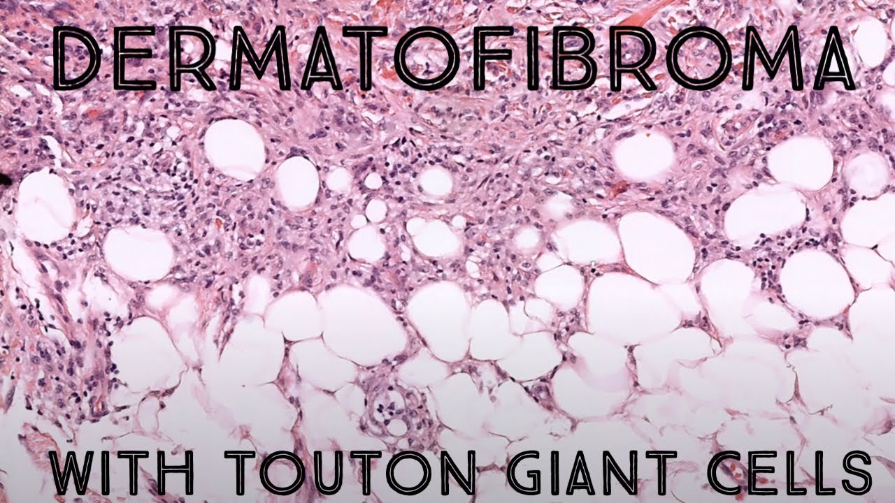 Dermatofibroma with hemosiderin laden Touton giant cells (pathology ...