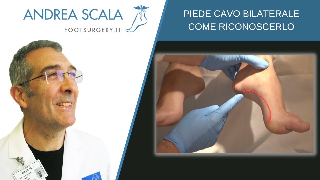 Piede cavo bilaterale: come riconoscerlo| Caratteristiche e sintomi ...