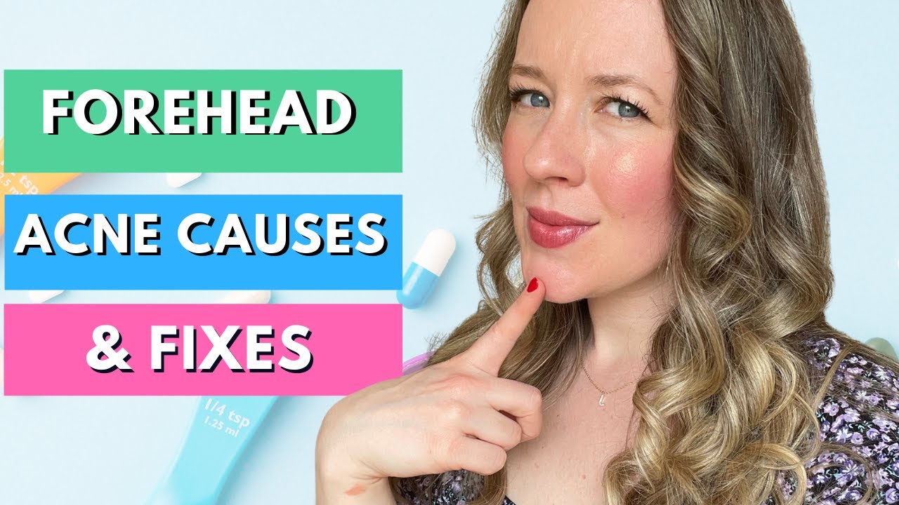 Pimples on forehead meaning - FOREHEAD ACNE TREATMENT! - YouTube