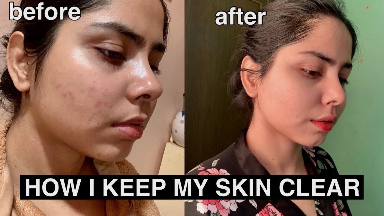 TOP 5 SKINCARE PRODUCTS FOR ANGRY/IRRITATED SKIN - YouTube