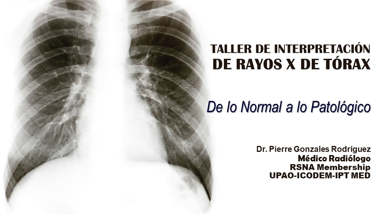 TALLER DE INTERPRETACIÓN DE RAYOS X DE TÓRAX「DE LO NORMAL A LO ...