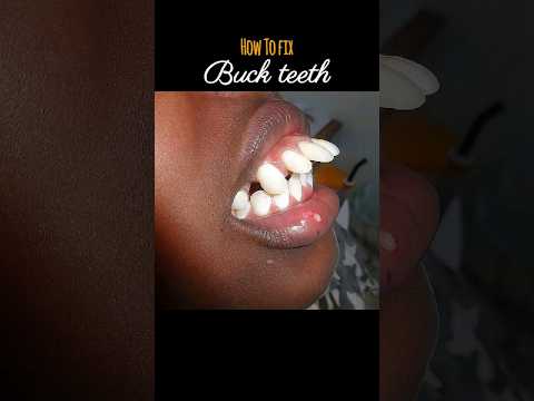 How Long Do You Need Braces For Buck Teeth