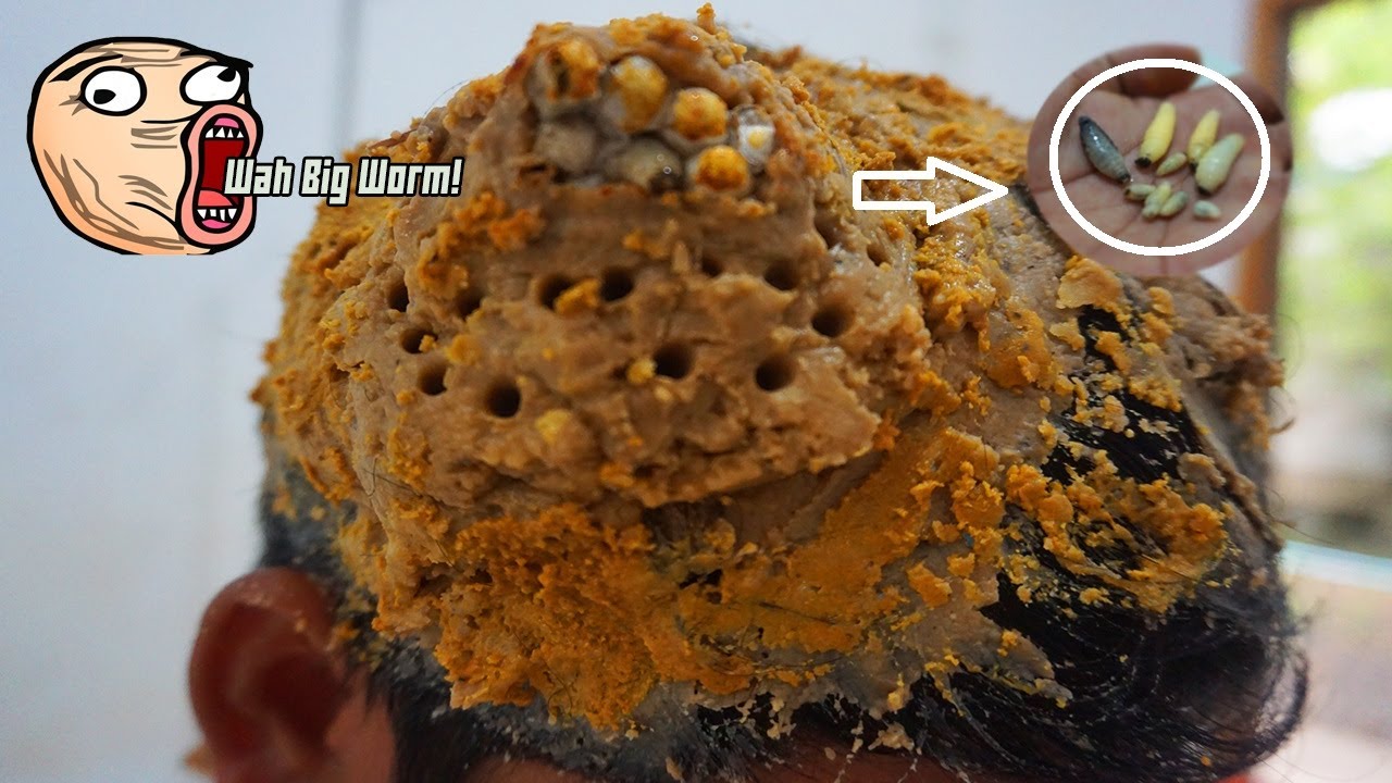Believe This Flake? Lots Of Worm Inside Dandruff Flakes Removal #395 ...