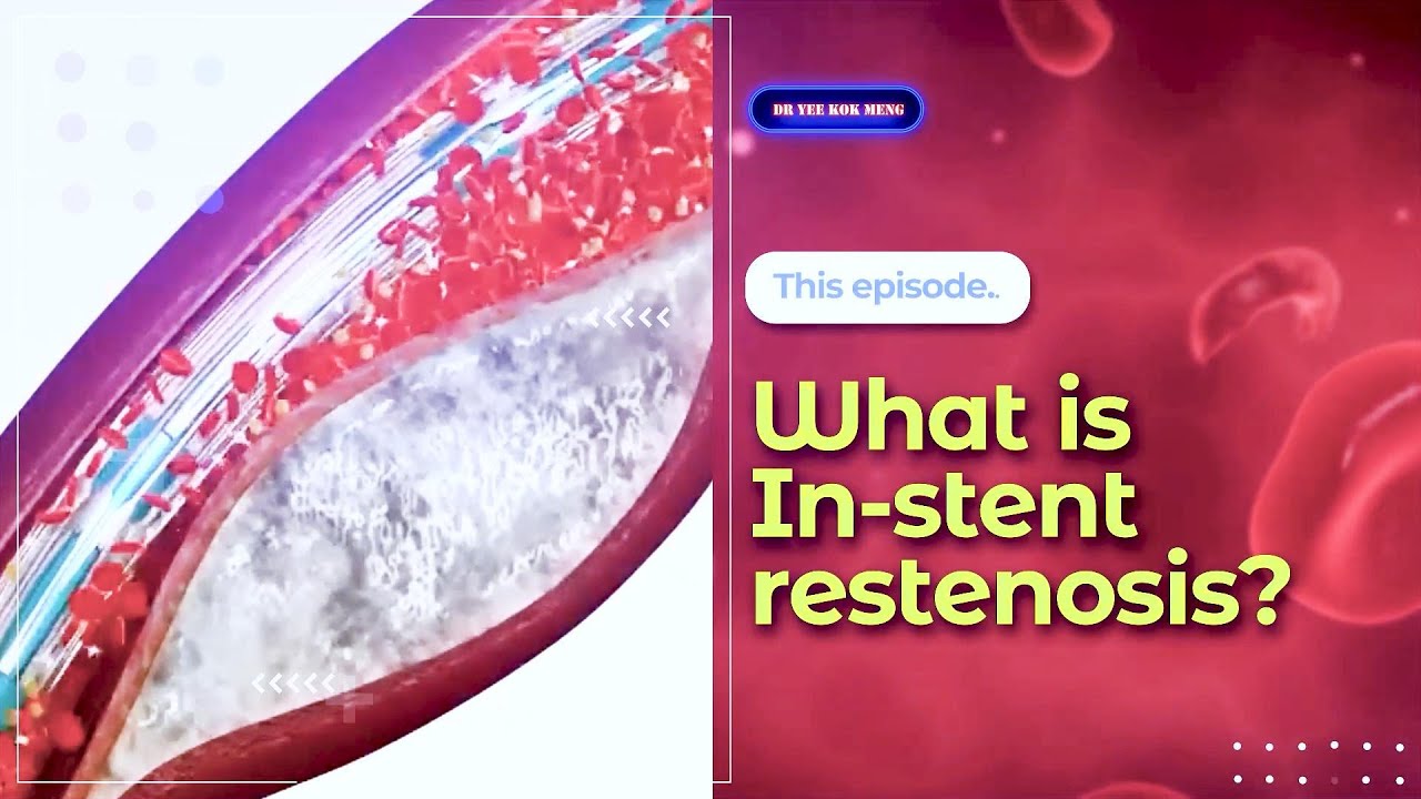 What is In-stent restenosis? - YouTube