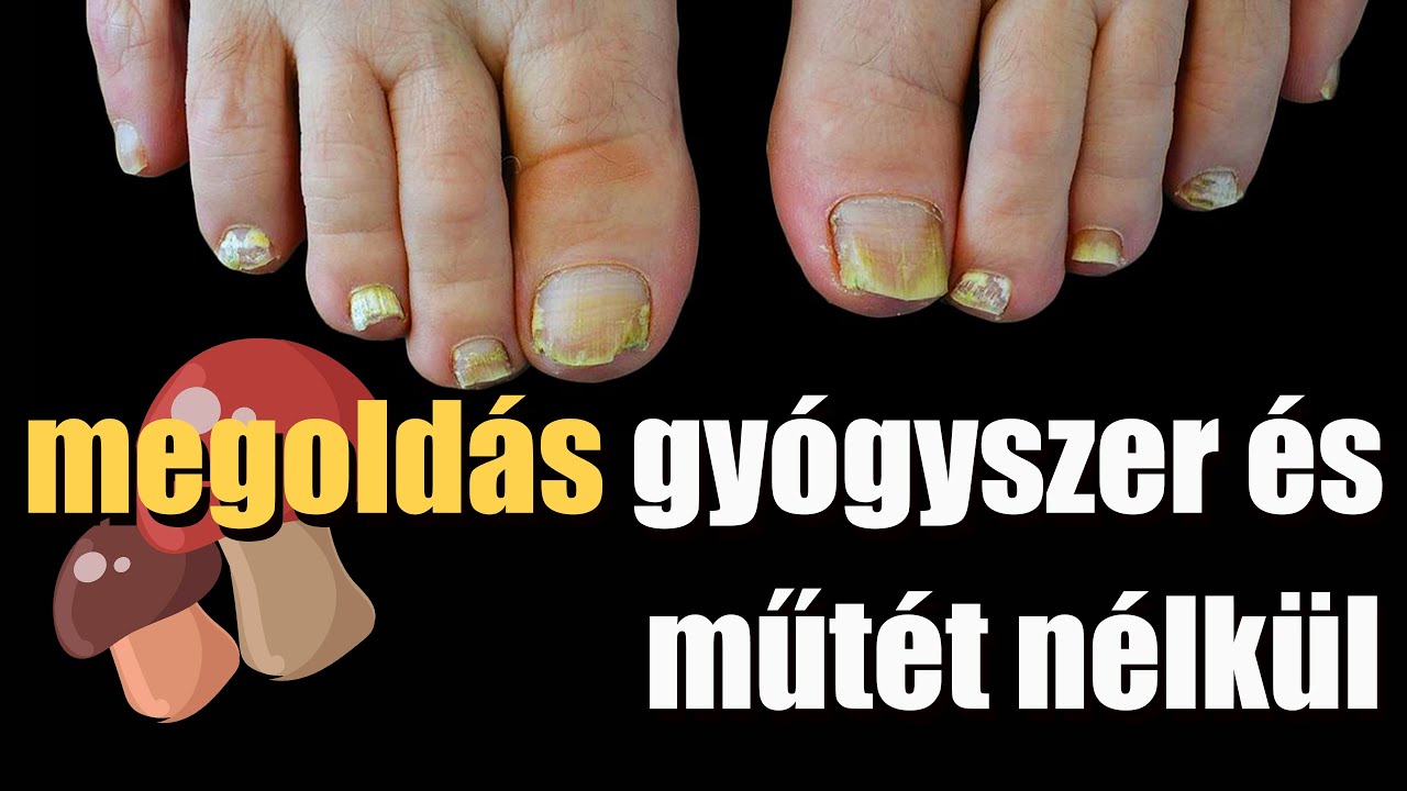 Körömgomba - és a megoldása műtét és gyógyszer nélkül - YouTube