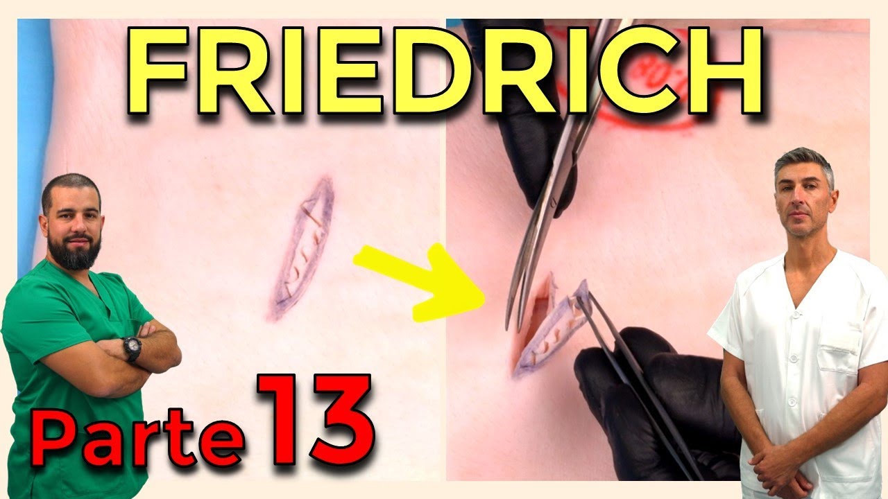 FRIEDRICH en HERIDAS – CIRUGÍA MENOR y SUTURAS (Parte 13) - YouTube