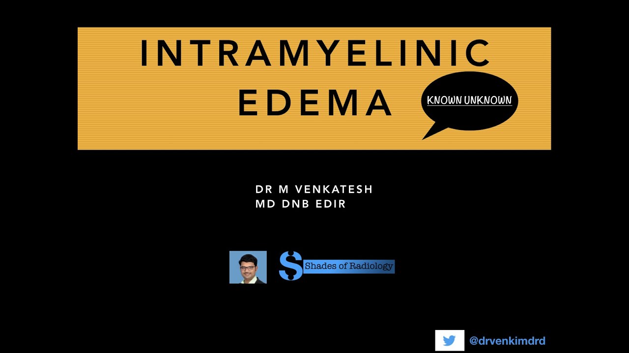 INTRAMYELINIC EDEMA - YouTube