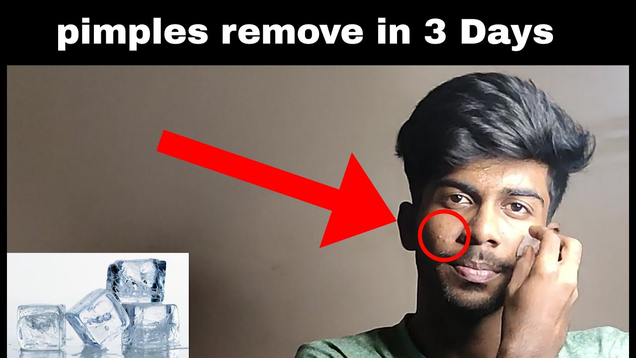 How to Remove PIMPLE in 3 DAYS ?🧖‍♂️| Important tip at end | தமிழ் ...