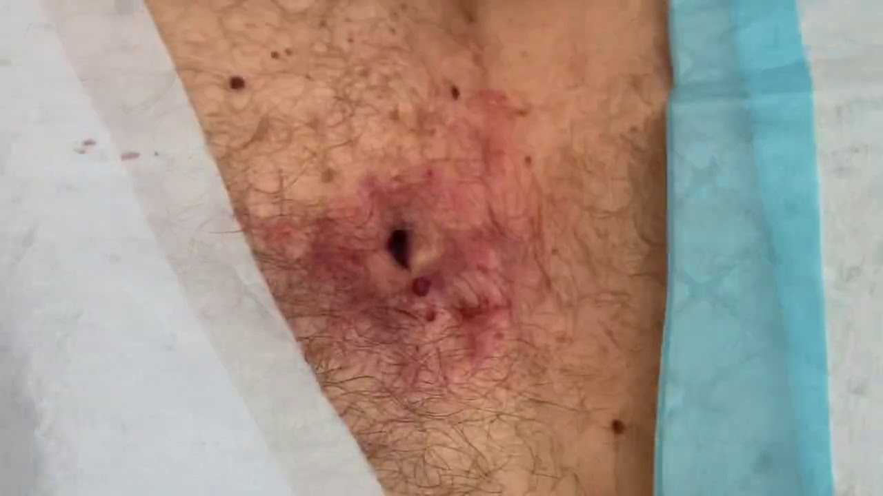 Giant Abscess