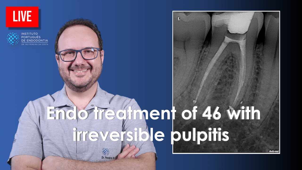 🔴 Endo treatment of 46 with irreversible pulpitis - YouTube