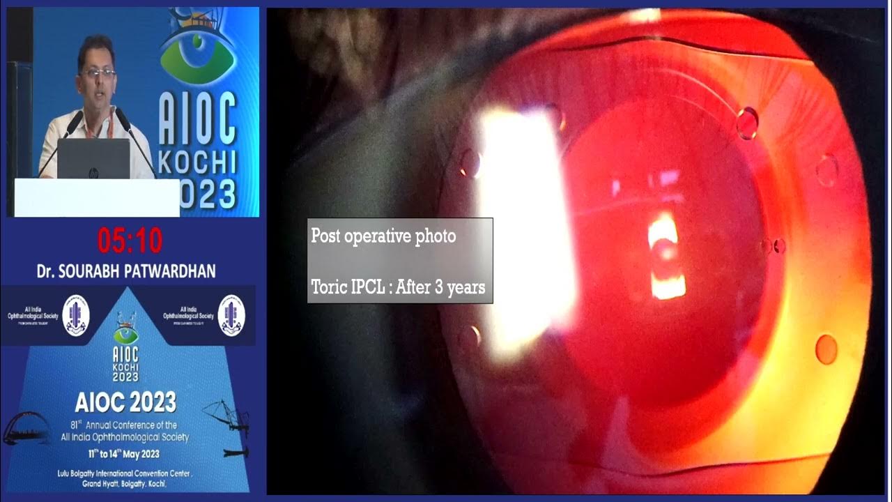AIOC 2023 IC551 topic Dr SOURABH PATWARDHAN Choosing the Right Fit in Phakic IOL’s - YouTube