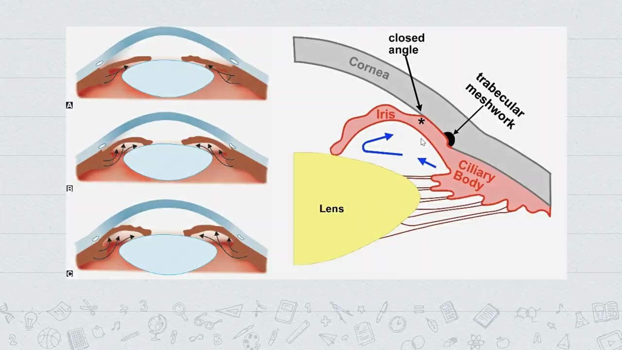Glaucoma - YouTube