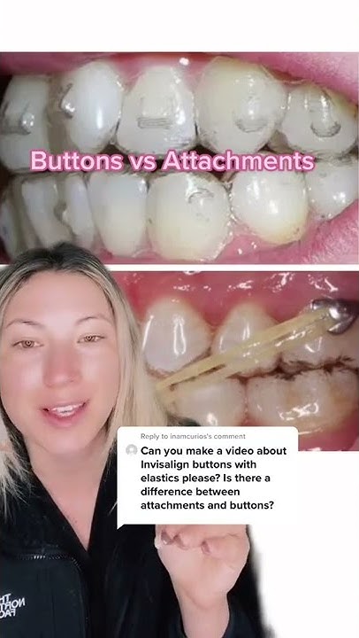 Invisalign: Attachments vs. Buttons #shorts - YouTube