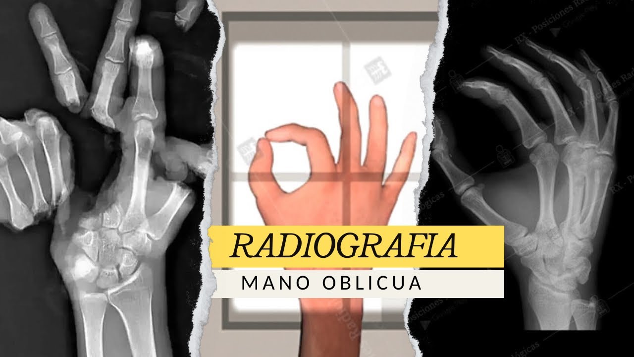 RADIOGRAFIA MANO OBLICUA (Radiología) #radiologia #radiology #medico ...