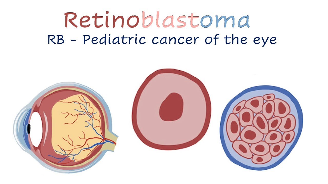 Retinoblastoma Description at Luis Silva blog