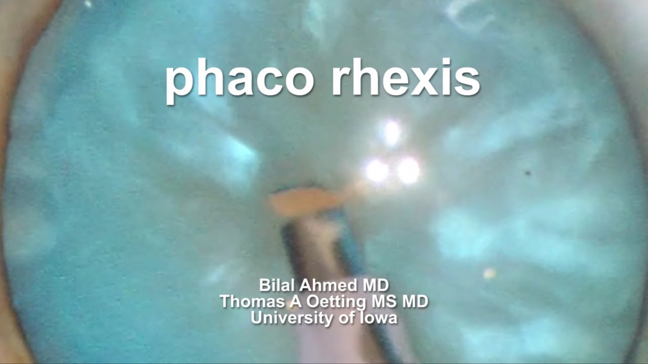 Phaco Rhexis White Cataract - YouTube